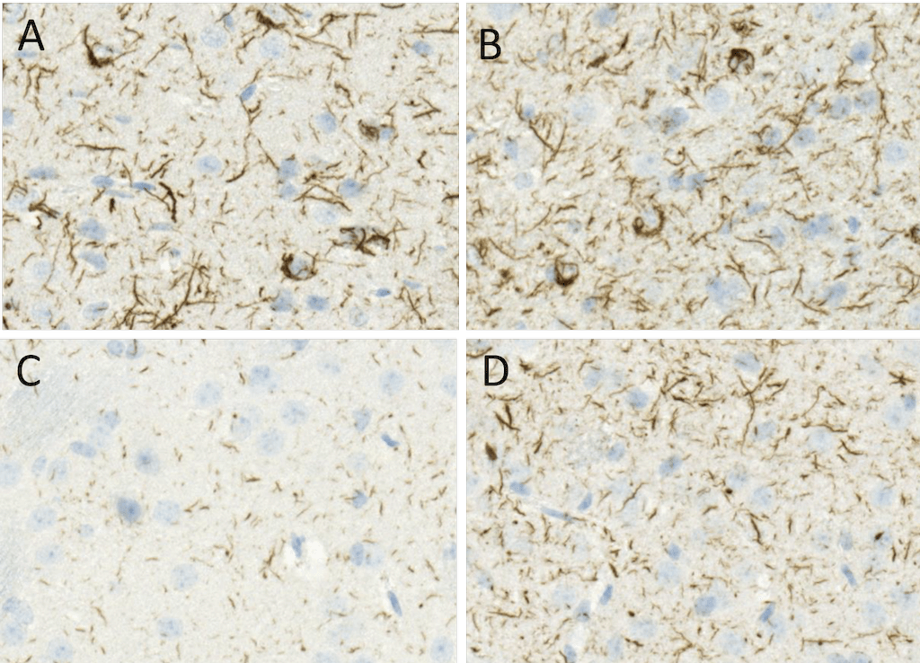 Alpha Synuclein Pre-formed Fibrils (Type 1) - 2BScientific